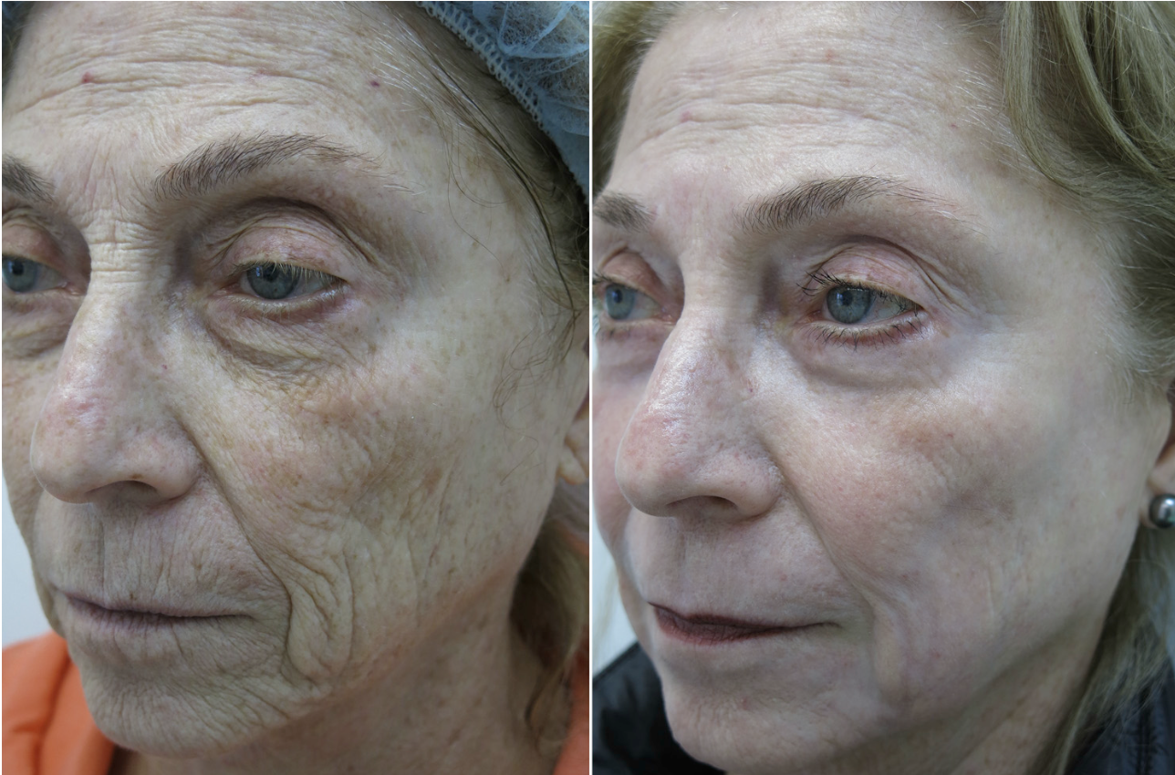Deep Chemical Peel | Derma Birmingham
